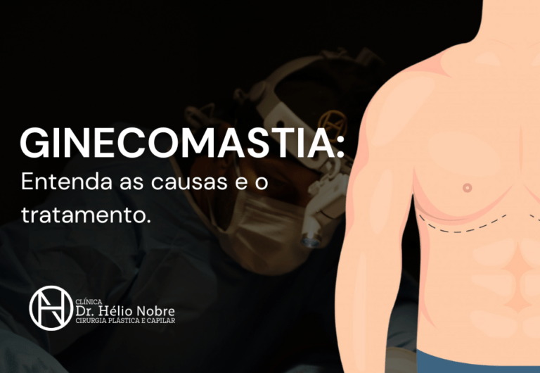 Cirurgia de Ginecomastia – Dr. Hélio Nobre